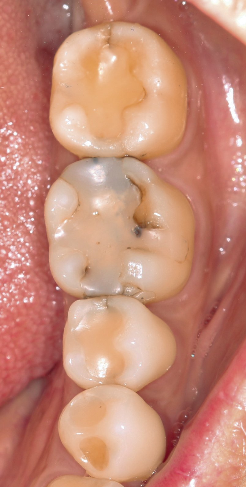 Clinical Guide: Transcend Composite